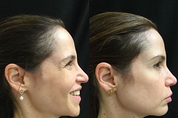 Botox Injections in Abu Dhabi 3